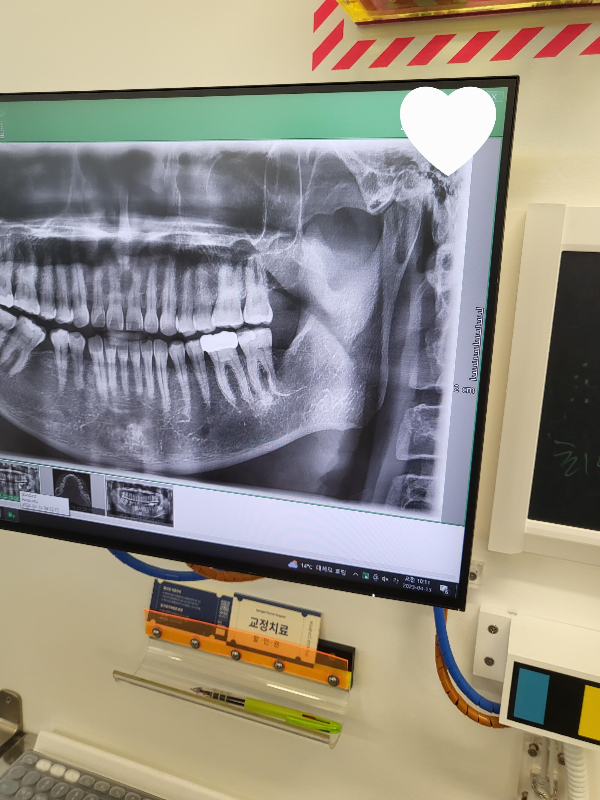 사랑니 발치전후 - DVDPrime