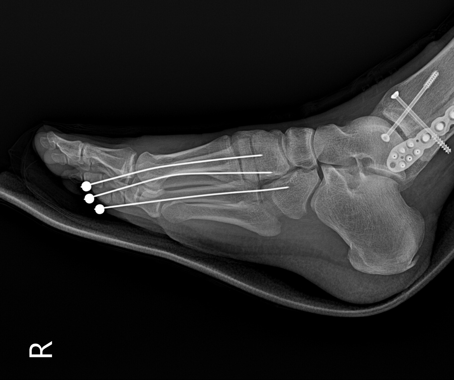 (혐주의 부상 x-ray) 전 이제 발 울버린입니다 2 - DPrime
