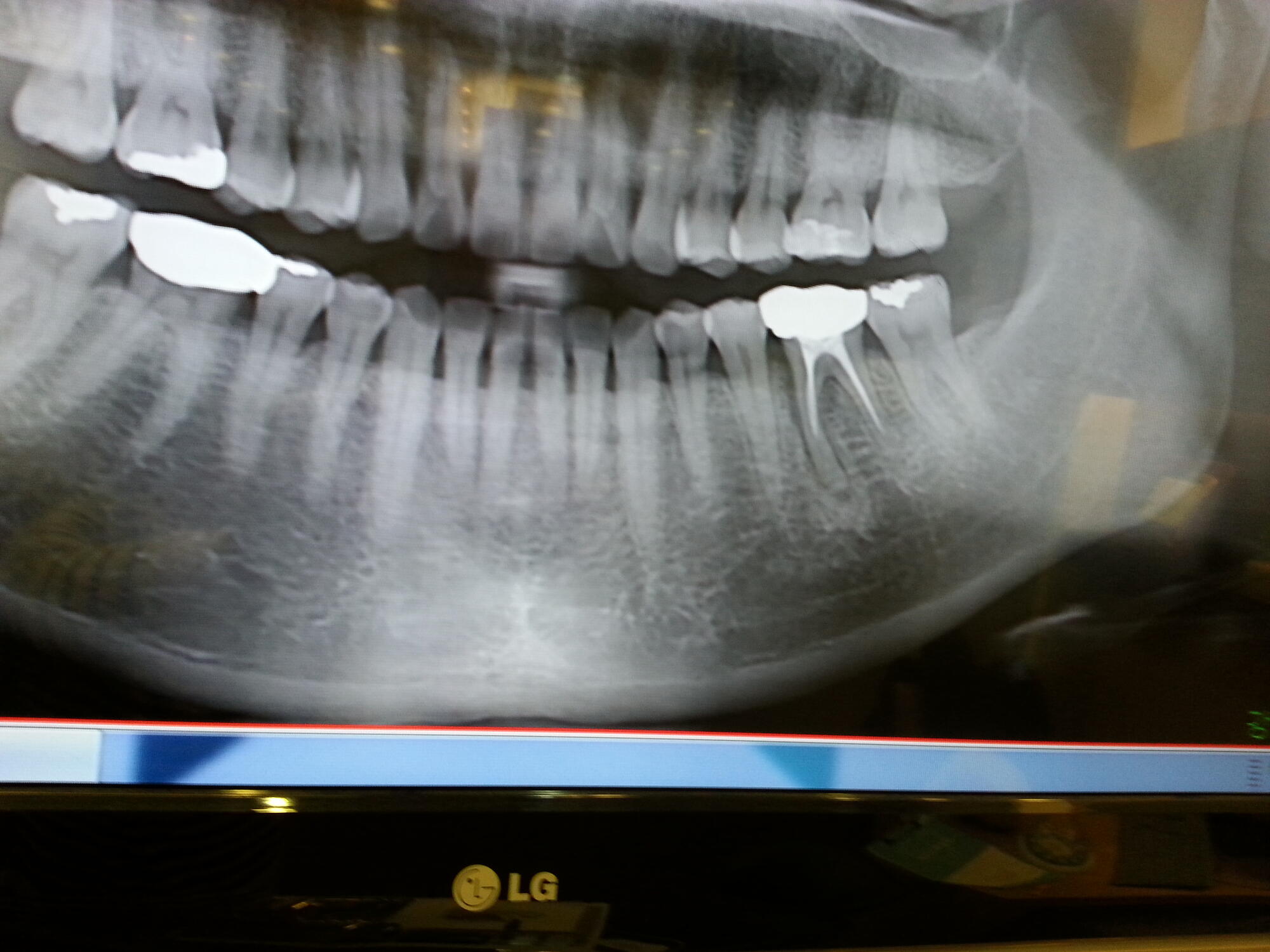 치과선생님들께 질문 있어요.. (임플란트? 브릿지?) - DVDPrime