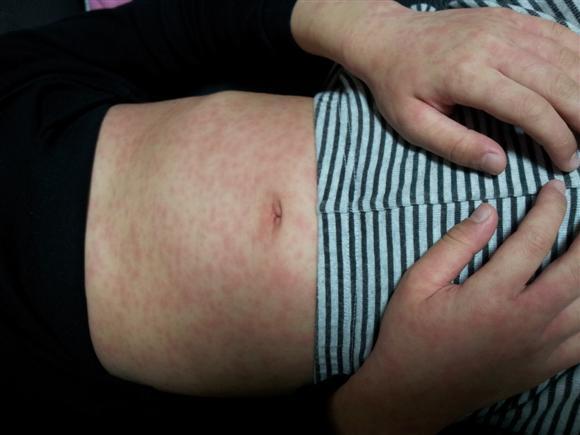 [DP지식인] 소아과/내과 의사분들 계시면 좀 봐주세요. 질문 죄송..-_-a - DVDPrime